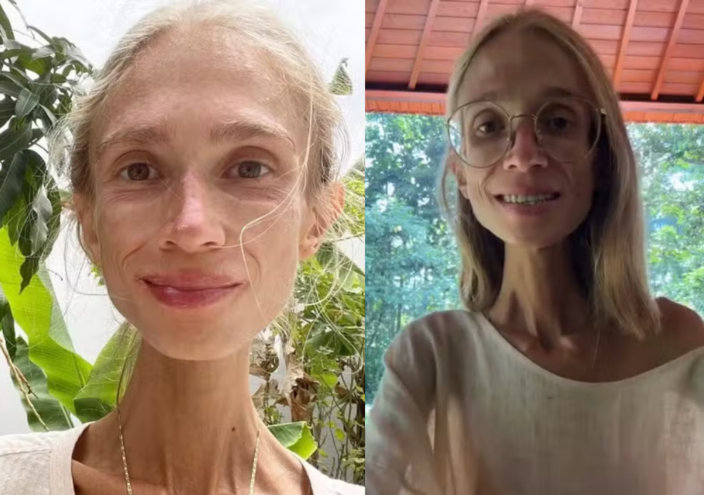Dançarina morre em Bali após dieta frutariana extrema que reduziu peso ...